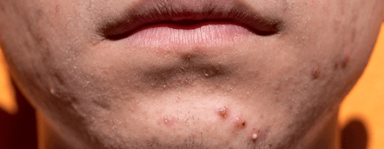 How To Find the Right Sunscreen for Your Acne-Prone Skin - Center For ...
