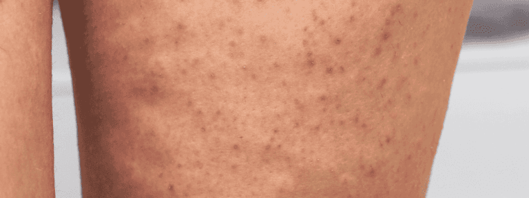 How To Treat Razor Bumps Down There – And Prevent Them from Coming Back ...